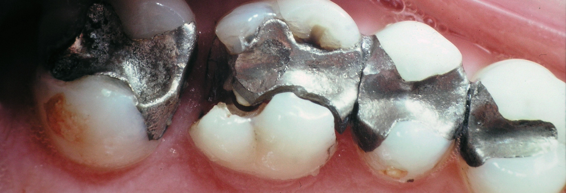 Dental Amalgams and Chronic Disease | CONEM Mercury Research